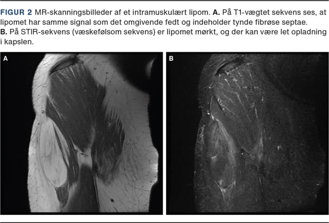 Udredning og behandling af lipomer | Ugeskriftet.dk