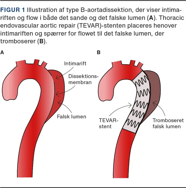 Stentning af ukompliceret type B-aortadissektion | Ugeskriftet.dk
