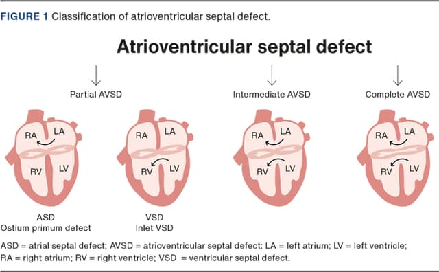 Live birth prevalence of atrioventricular septal defect after the implementation of new prenatal ...