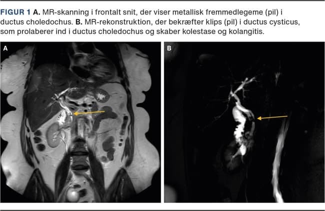 Akut kolangitis på grund af metalklips i ductus choledochus efter ...