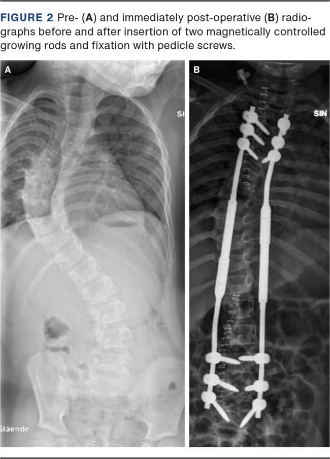 Magnetically controlled growing rods in early-onset scoliosis ...