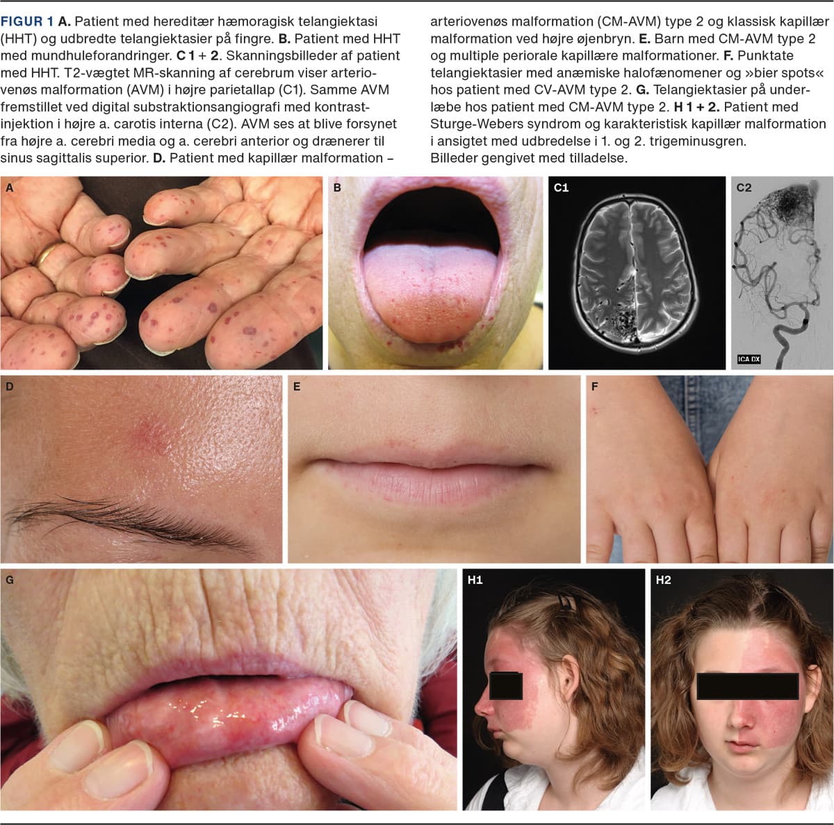 Kutane kapillære malformationer med cerebral involvering | Ugeskriftet.dk