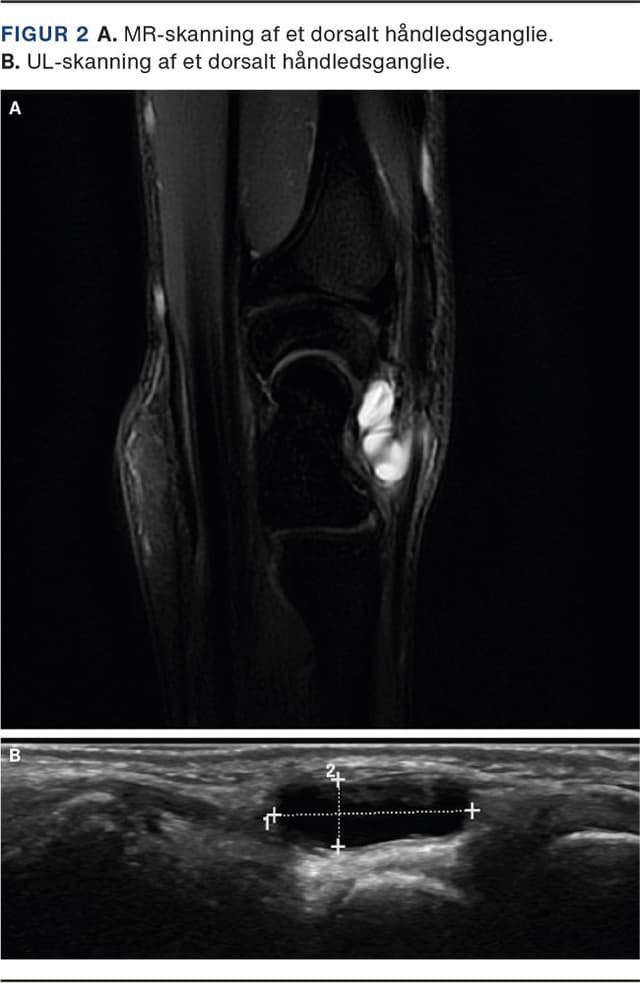 Ganglier på håndled og hånd | Ugeskriftet.dk