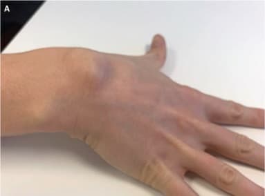 Diagnostik og behandling af ganglier omkring hånd og håndled ...