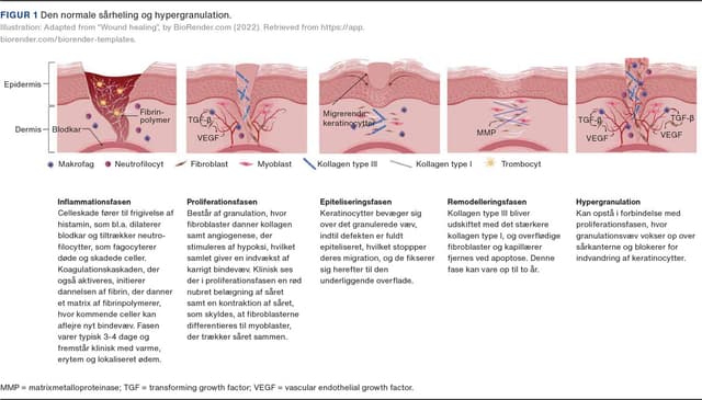 Konservativ behandling af iatrogen mælkefistel | Ugeskriftet.dk