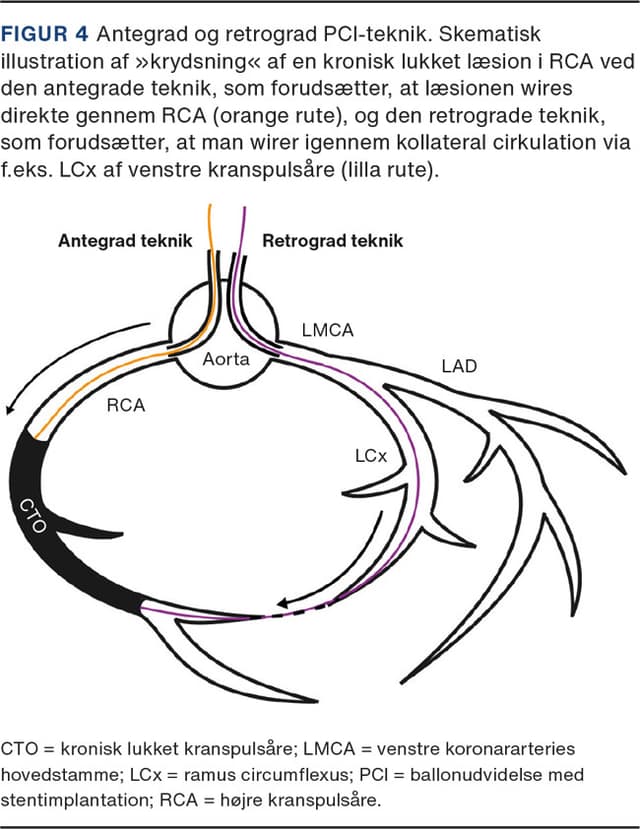 Konservativ versus invasiv behandling af patienter med kronisk lukket kranspulsåre | Ugeskriftet.dk