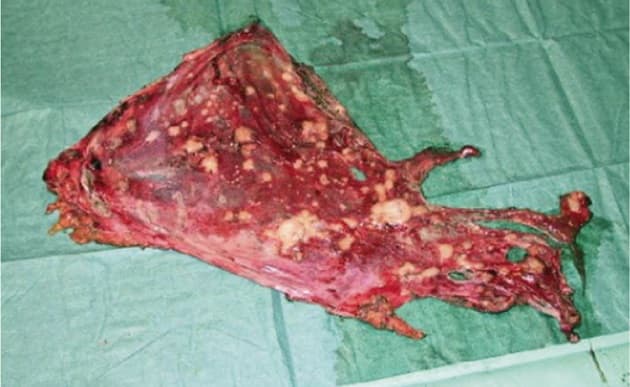 Behandling af peritoneale metastaser fra kolorektal cancer | Ugeskriftet.dk