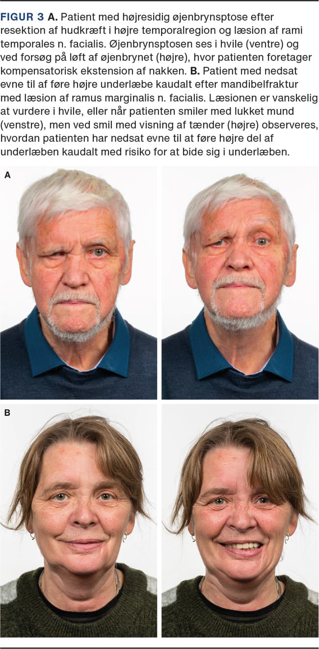 Behandling af traumatiske skader på perifere n.facialis | Ugeskriftet.dk