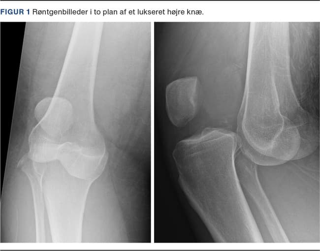 Traumatisk knæluksation | Ugeskriftet.dk