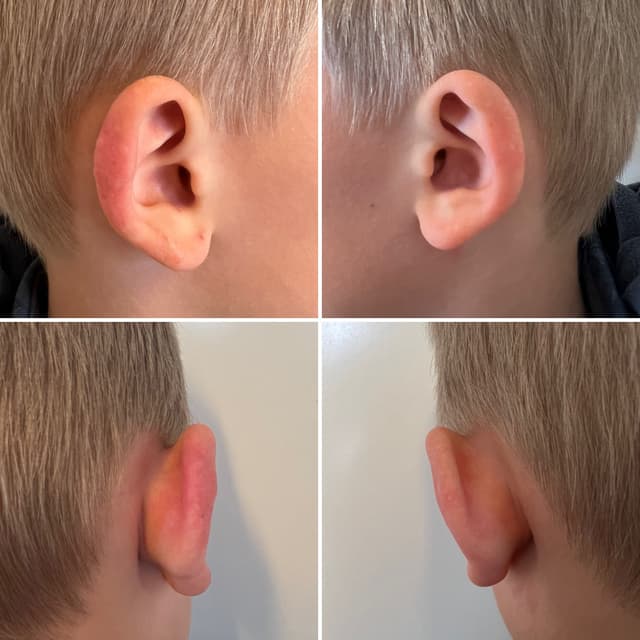 Juvenile spring eruption | Ugeskriftet.dk