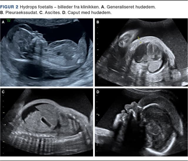 Hydrops foetalis | Ugeskriftet.dk