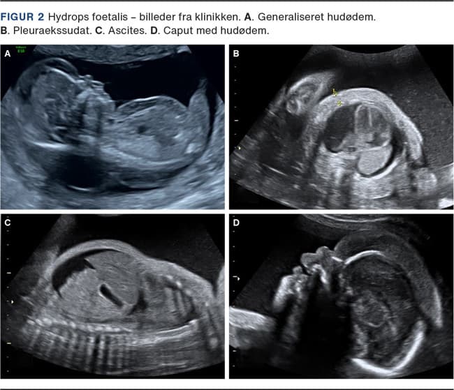 Hydrops foetalis | Ugeskriftet.dk