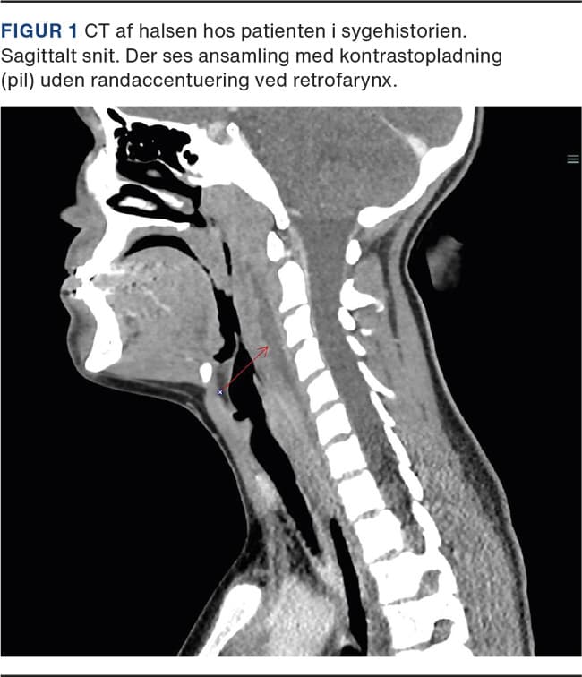 Retrofaryngealt ødem som atypisk præsentation af multiple inflammatory ...