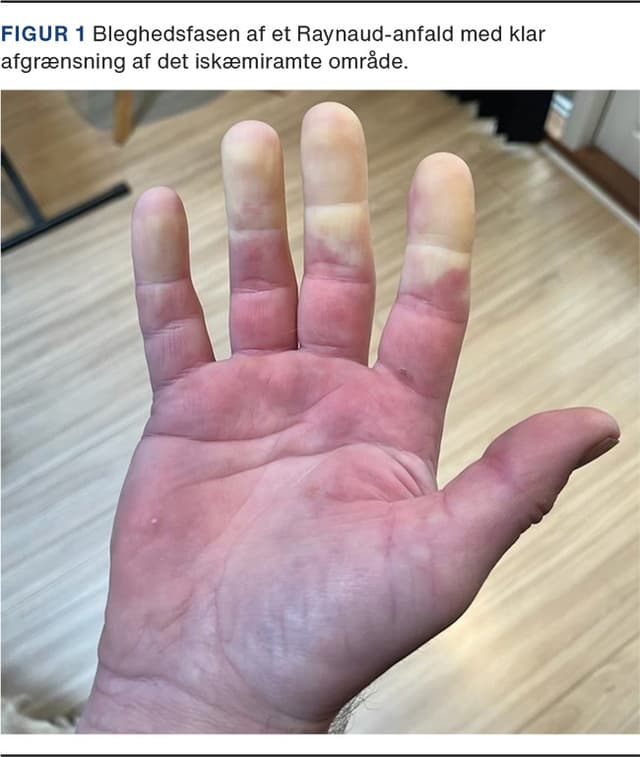 Raynauds syndrom | Ugeskriftet.dk