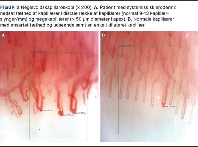 Raynauds syndrom | Ugeskriftet.dk