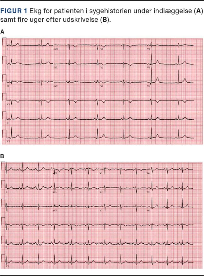 Atypisk præsentation af svær præeklampsi med sinusbradykardi og ...