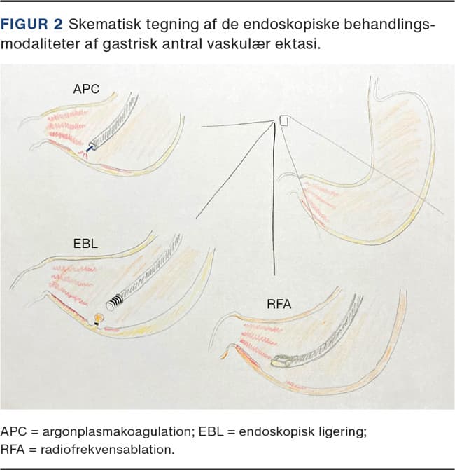 Endoskopisk behandling af gastrisk antral vaskulær ektasi | Ugeskriftet.dk