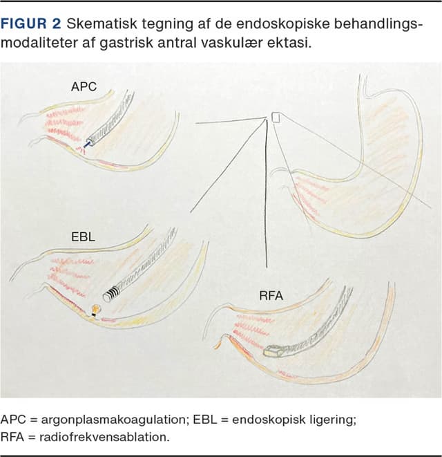 Endoskopisk behandling af gastrisk antral vaskulær ektasi | Ugeskriftet.dk