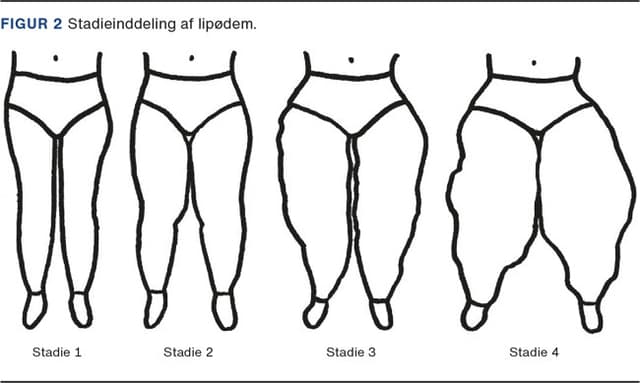 Lipødem | Ugeskriftet.dk